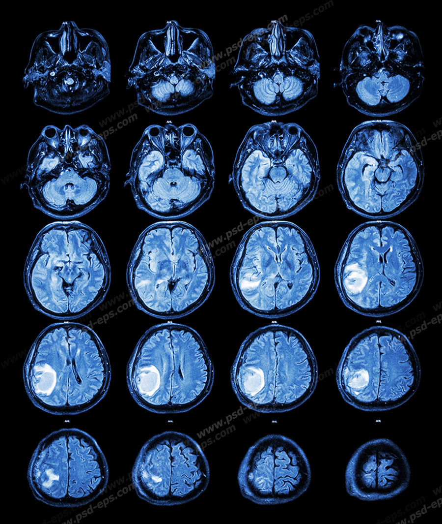 عکس با کیفیت آزمایش MRI مغزی جهت تشخیص بیماریهای مغز و اعصاب و تومورهای ...